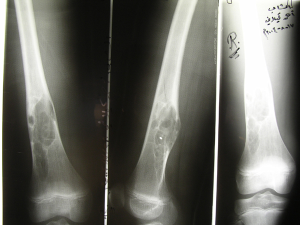 Pathologic Fractures In Adults - alliancepriority