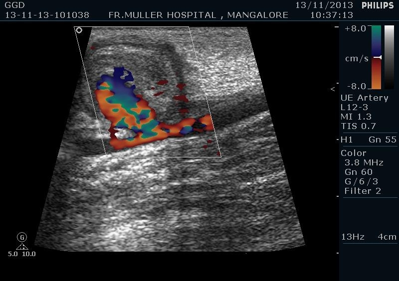 Laminar Blood Flow Seen In A Brachial Artery Ultrasound